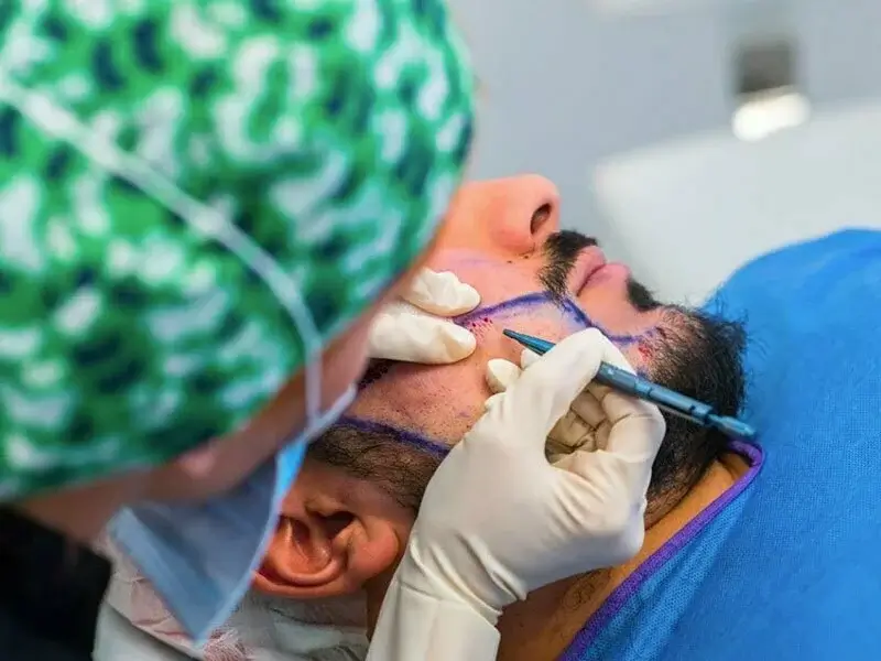 A Step-by-Step Guide to Beard Transplant Surgery | Global Medical Care