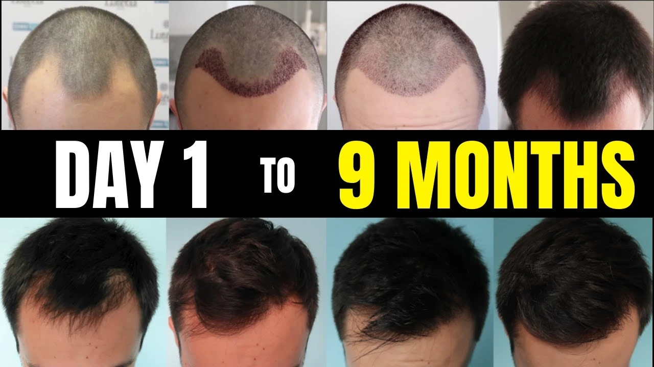 Hair Transplant Timeline: A Step-by-Step Guide | Global Medical Care